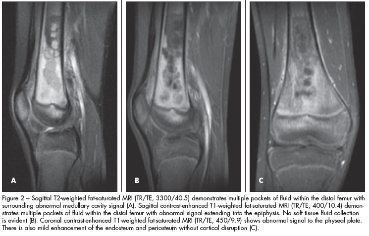 Case in Point: Acute Osteomyelitis: Radiographs Versus MRI | Consultant360